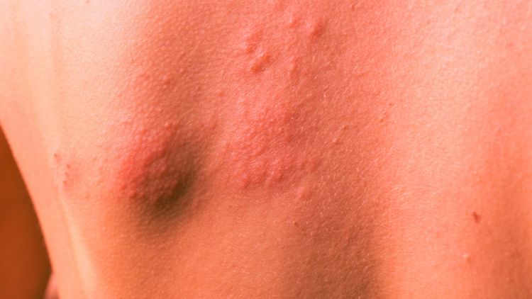 Shingles Vaccine Shocks Researchers With Surprising Heart Health Outcome