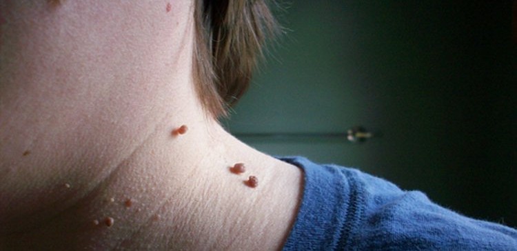 Skin Tags: What They Are and How to Get Rid of Them